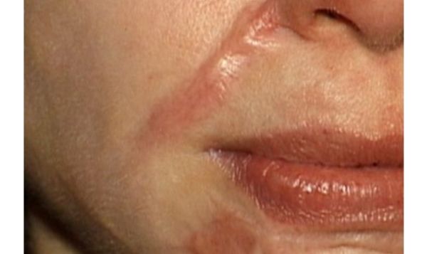 How do scarification wounds heal? - DesignGuide
