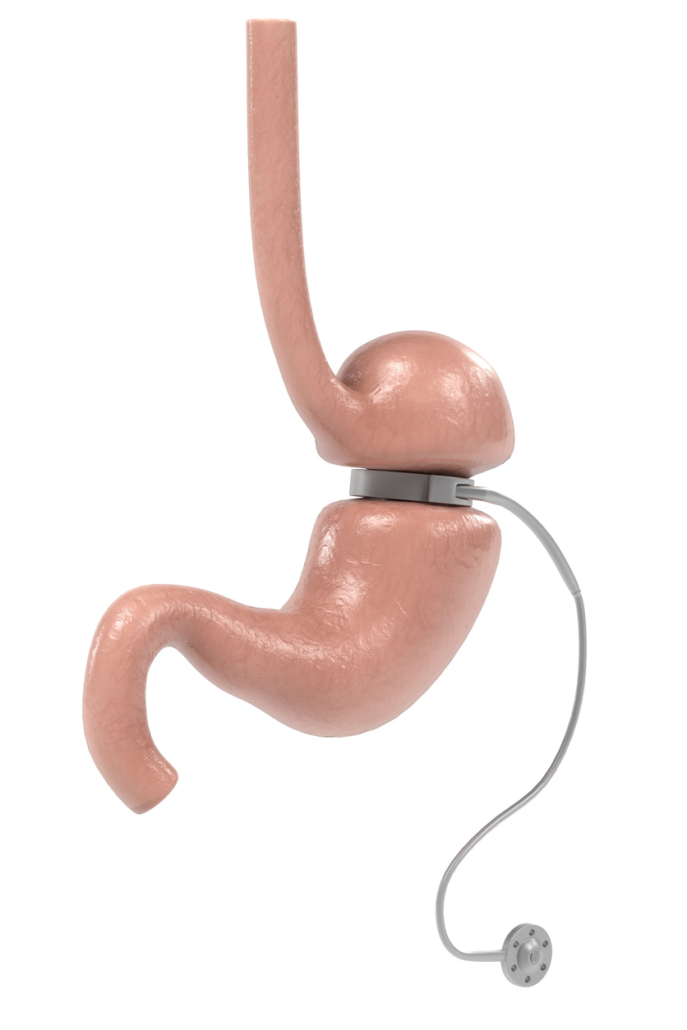 Best Gastric Band Surgery Treatments and Hospitals | Dr Prem Medical ...